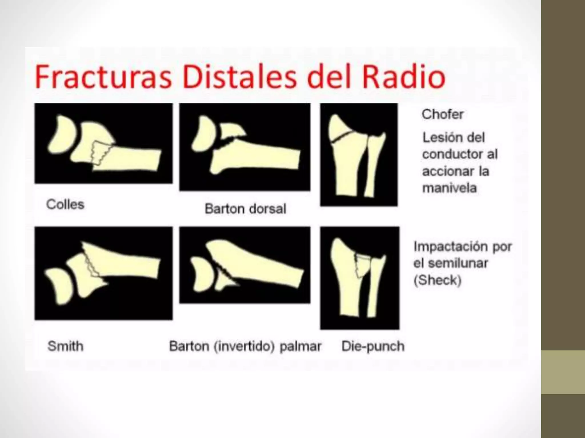 Fracturas de radio distal | PPTX