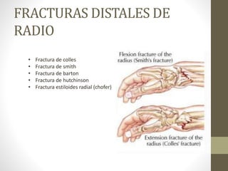 Fracturas de radio distal | PPTX