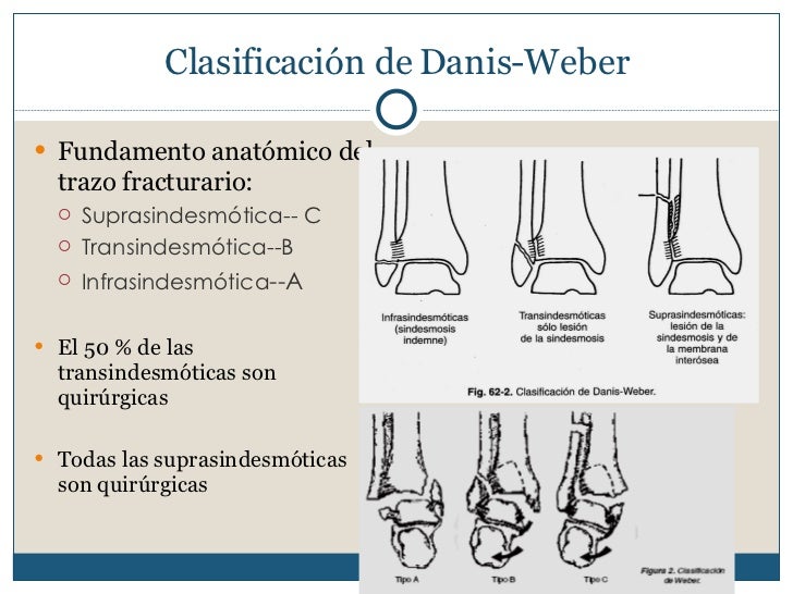 Fracturas De Tobillo