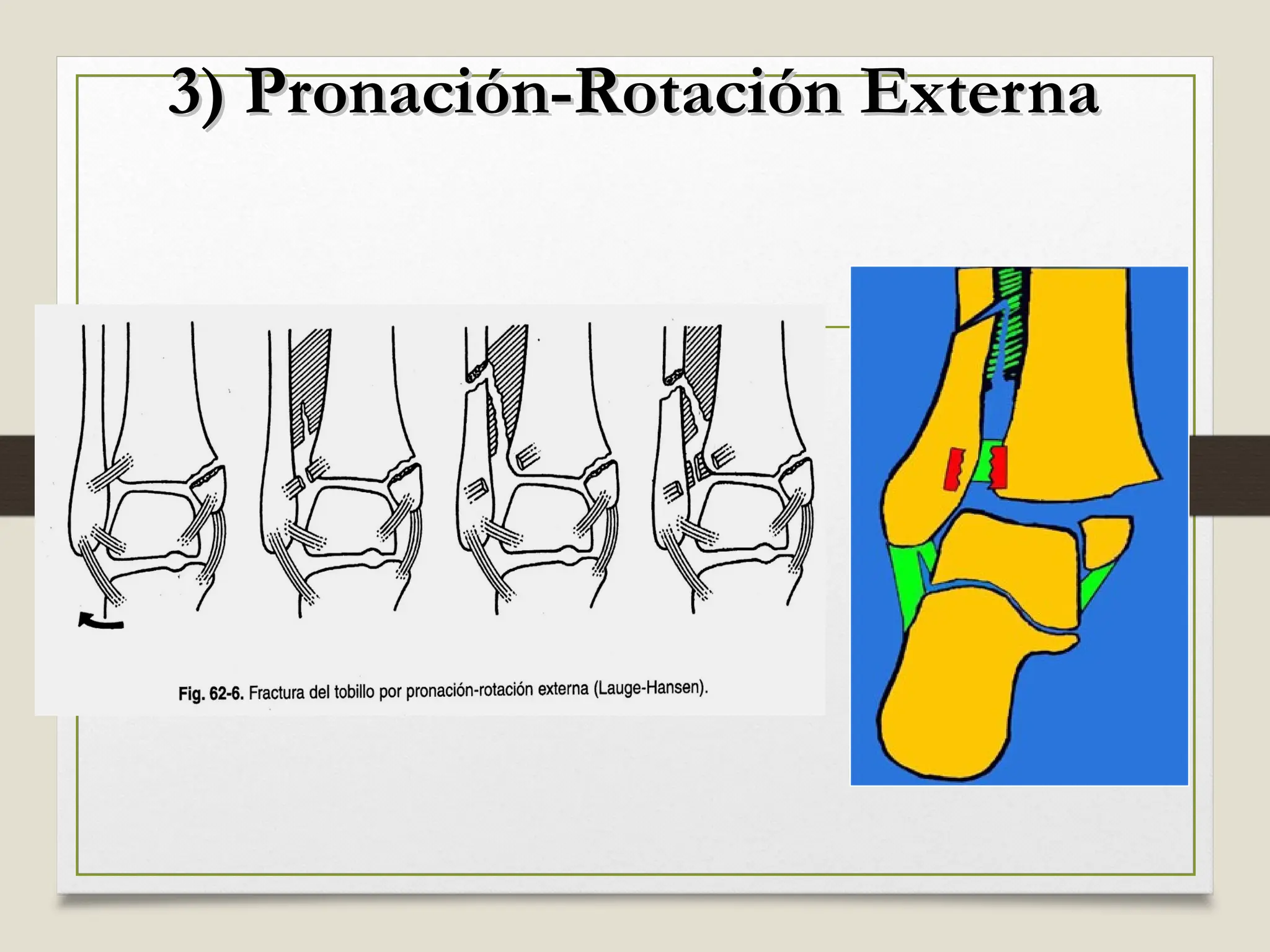 fracturas-de-tobillo-Clasificación de Lauge-Hansen.ppt