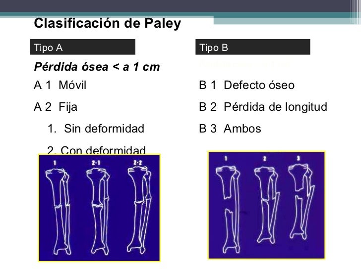 Fracturas Generalidades Y Consolidación 2011