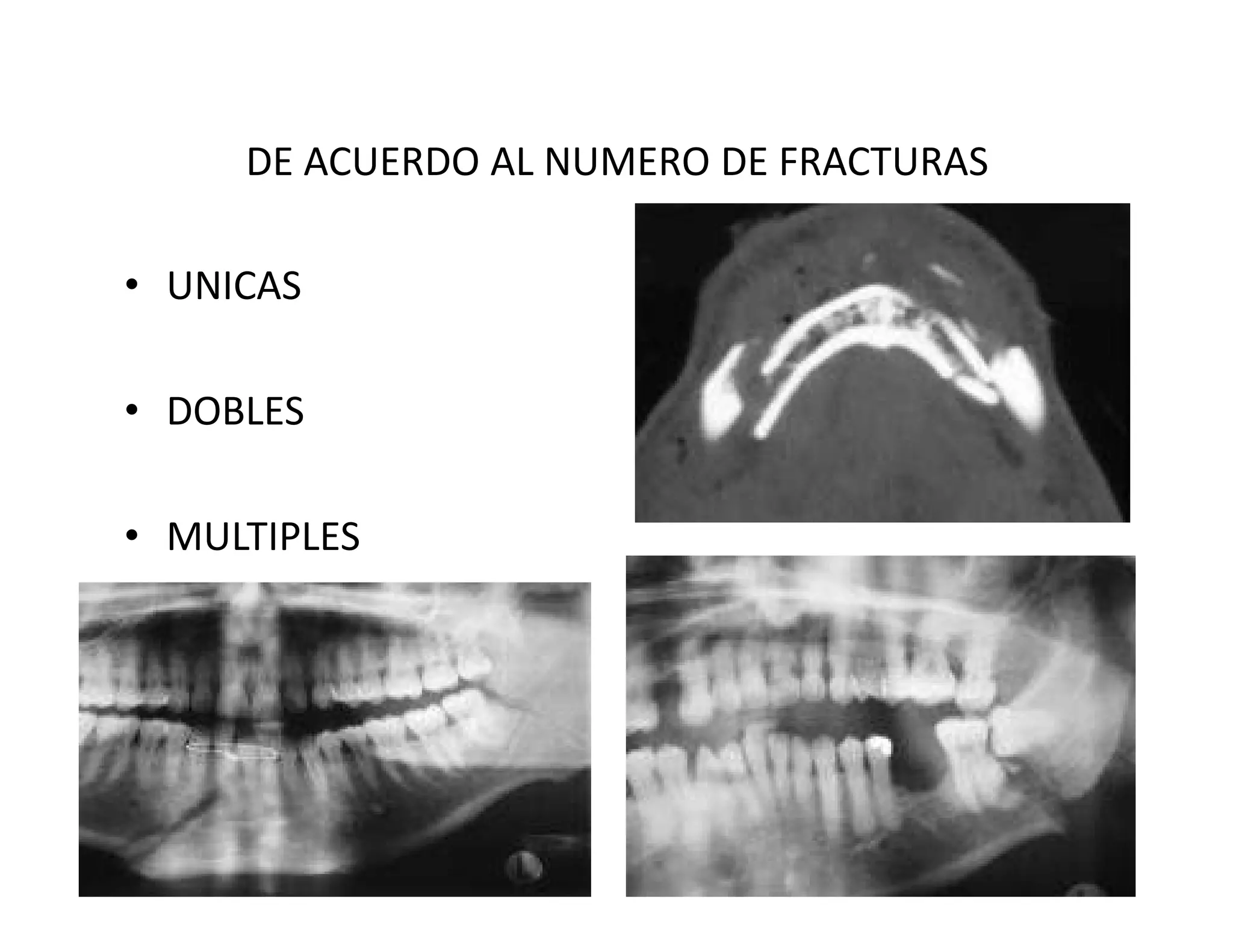 Fracturas Mandibulares | PPT