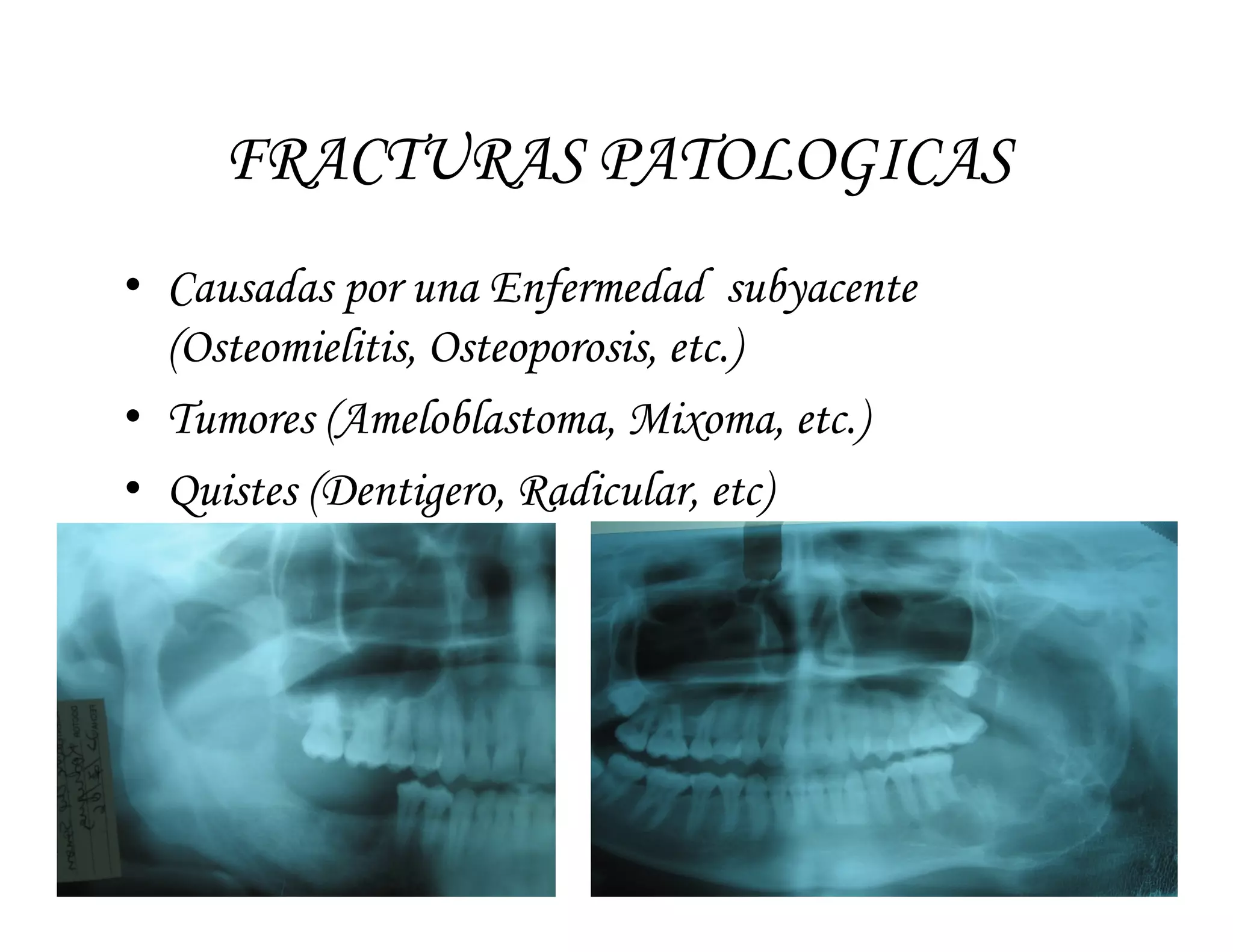 Fracturas Mandibulares | PDF