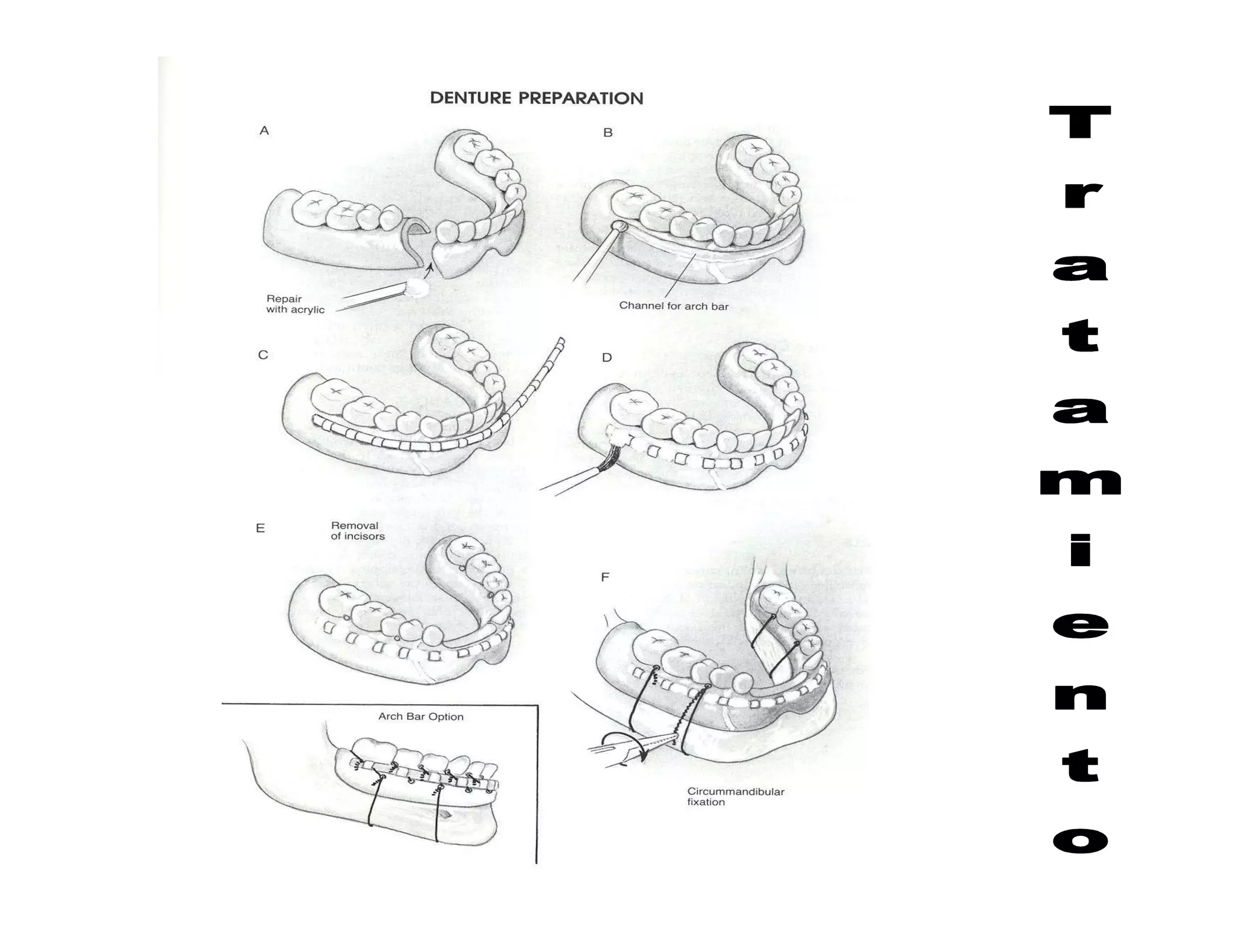 Fracturas Mandibulares | PDF