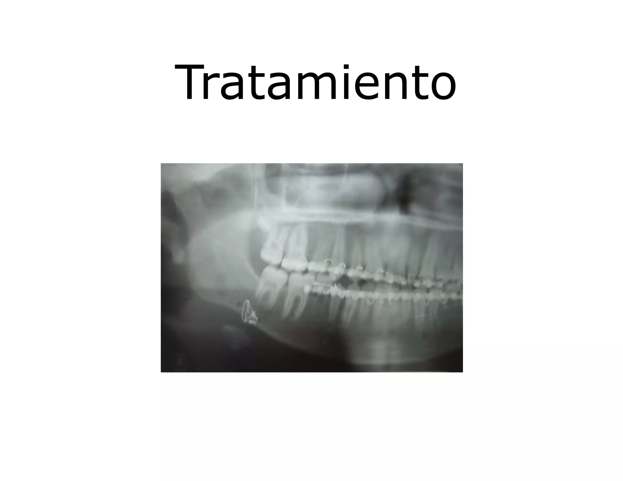 Fracturas Mandibulares | PDF