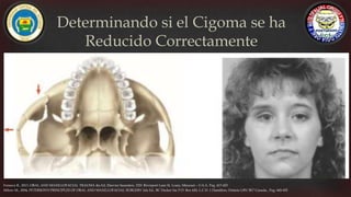 Fracturas cigomaticas | PPTX