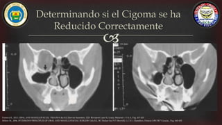 Fracturas cigomaticas | PPTX
