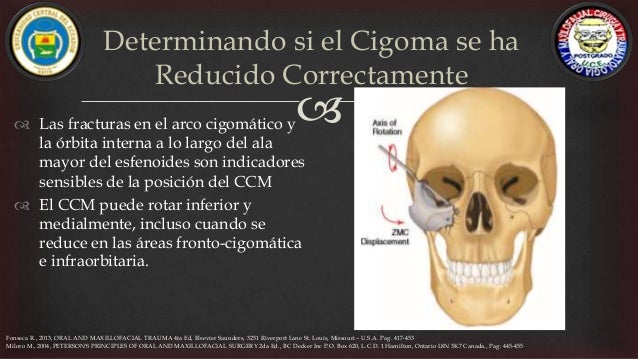 Fracturas cigomaticas