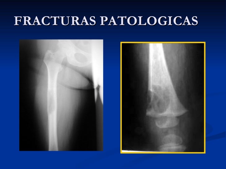Fracturas Clasificacion