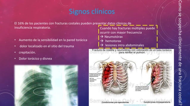 Fracturas costales | PPT | Descarga Gratuita