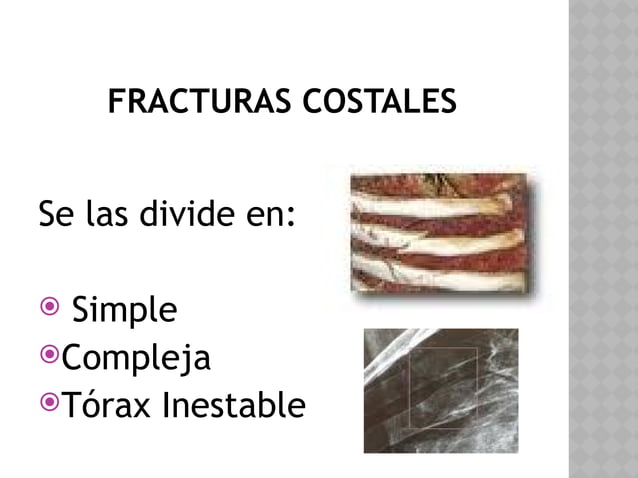 Fracturas Costales, VOLET COSTAL, PARRILLA COSTAL | PPT