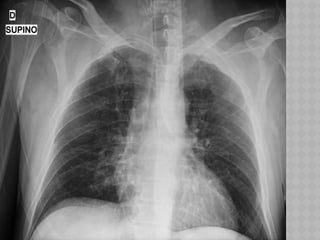 Fracturas Costales, VOLET COSTAL, PARRILLA COSTAL | PPTX