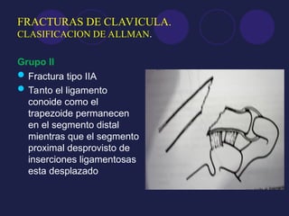 FRACTURAS DE CLAVICULA 4to año medicina.ppt