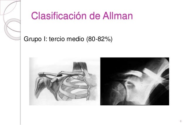 Fracturas de clavicula escapula luxacion
