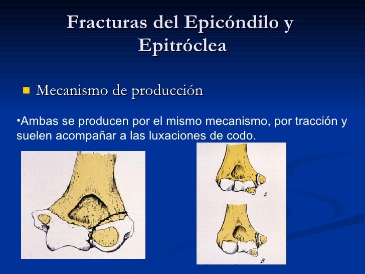 Fracturas De Codo