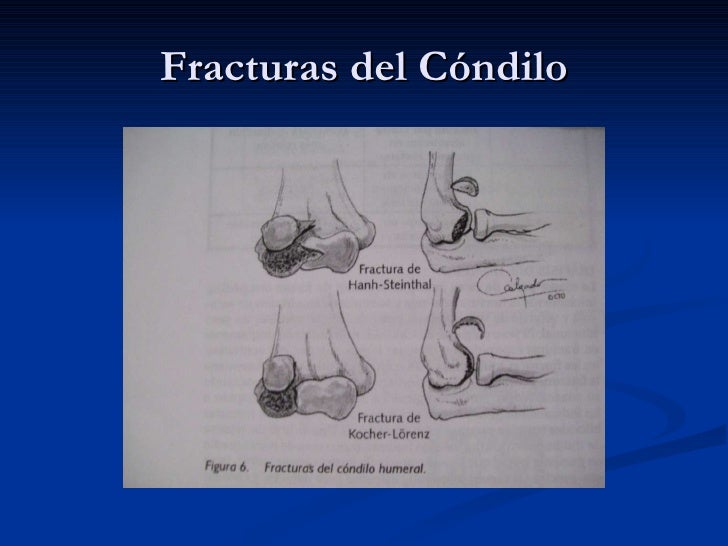 Fracturas De Codo