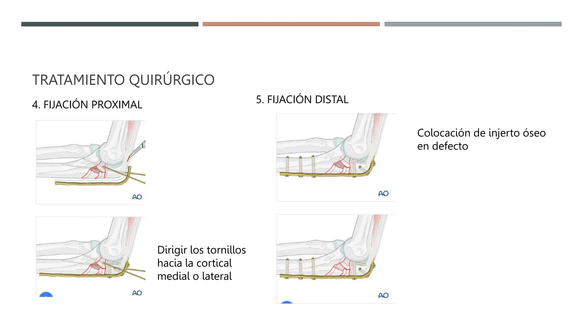 FRACTURAS DE RADIO Y CUBITO PROXIMAL CODO.pptx