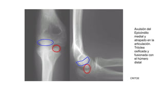 Fracturas de codo en niños tratamiento .pdf