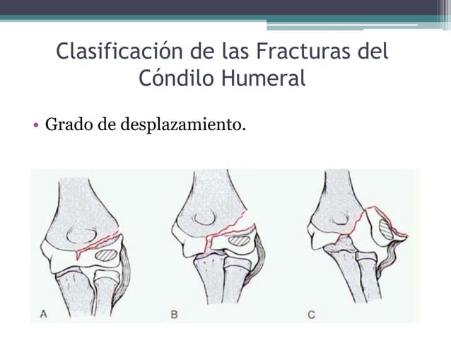 Fracturas de codo, ,muñeca y mano | PPTX