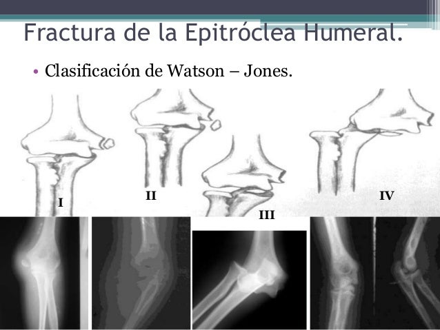Fracturas de codo, ,muñeca y mano