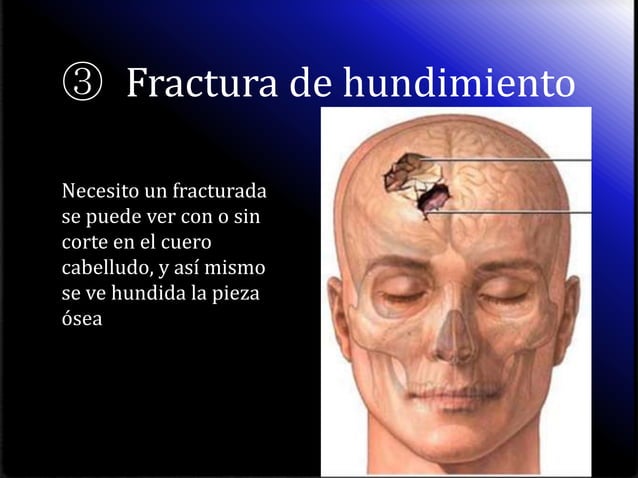 Fracturas de craneo
