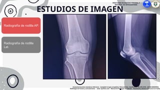 FRACTURAS DE DIAFISIS DE FEMUR EN EL ADULTO Y PEDIÁTRICOS pptx | PPTX