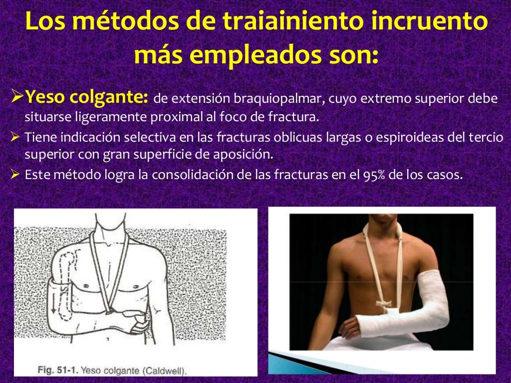 Fracturas de diafisis del humero