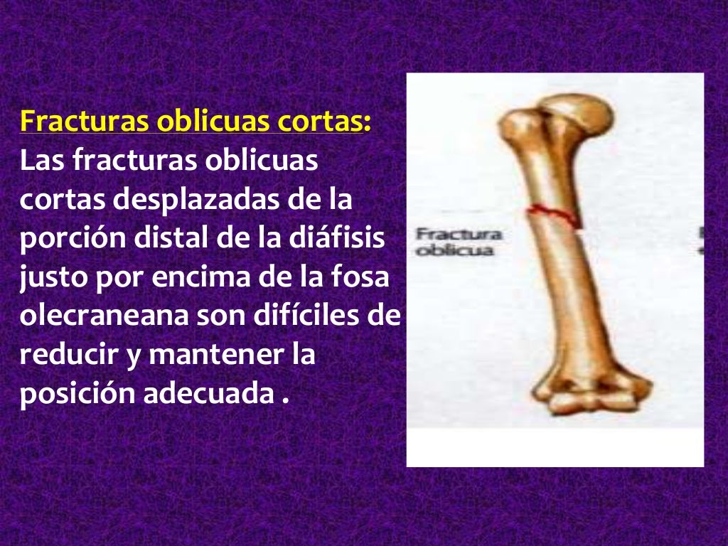 Fracturas de diafisis del humero