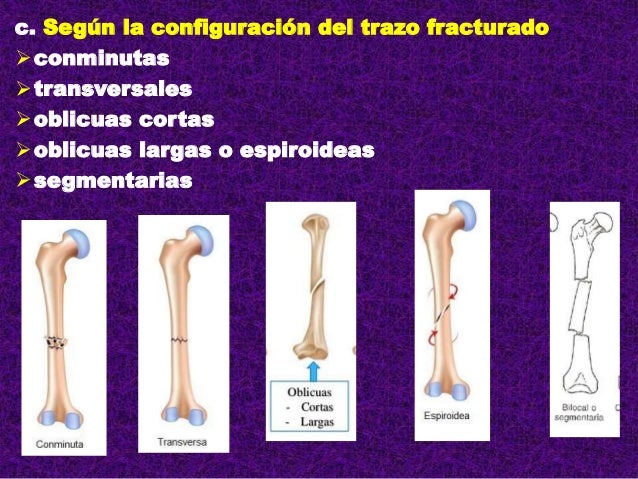 Fracturas de diafisis del humero