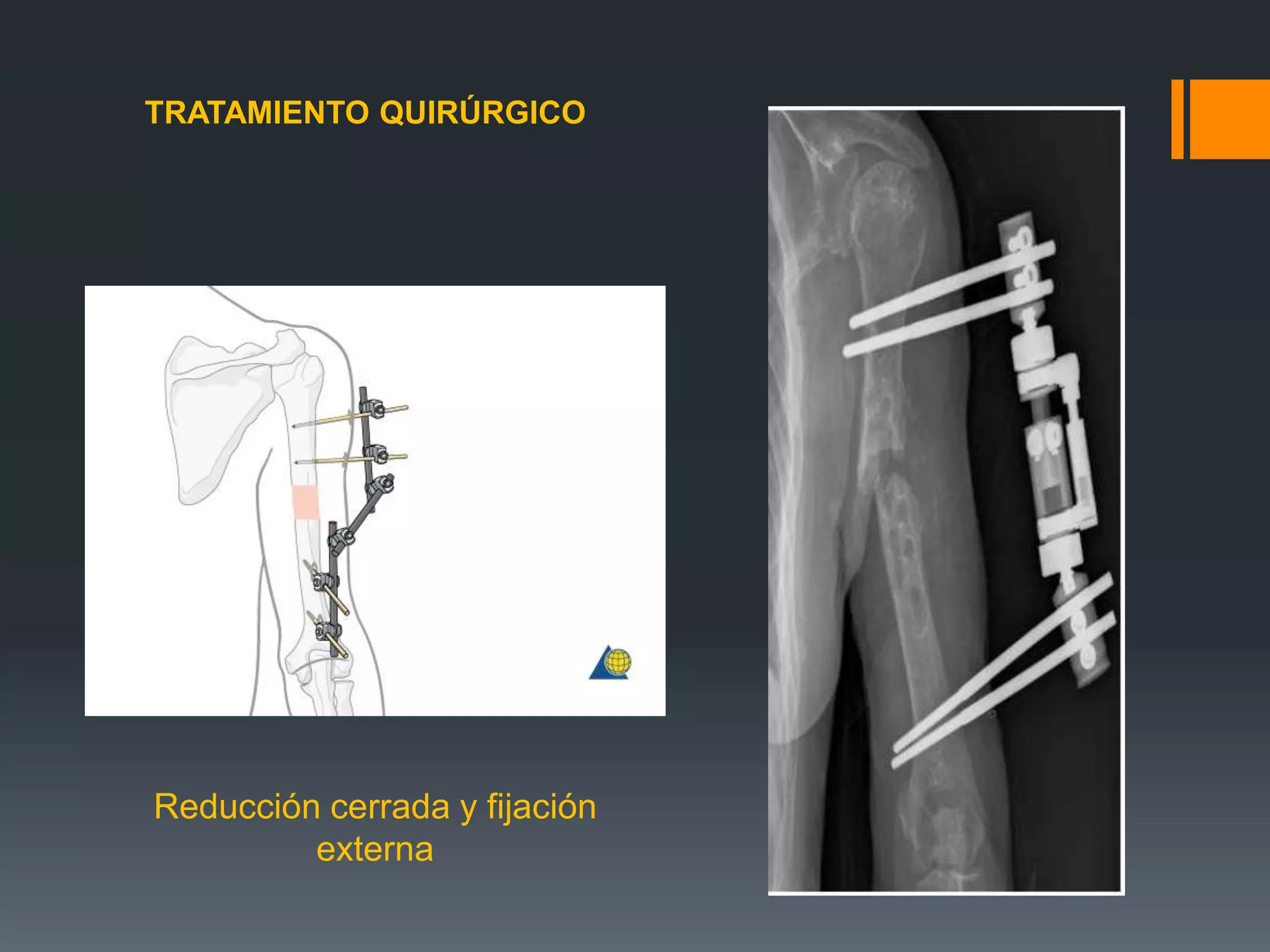 Fracturas de diafisis del humero | PPTX