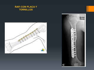 Fracturas de diafisis del humero | PPTX