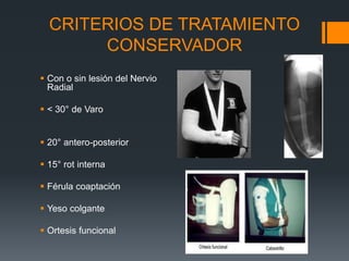 Fracturas de diafisis del humero | PPTX