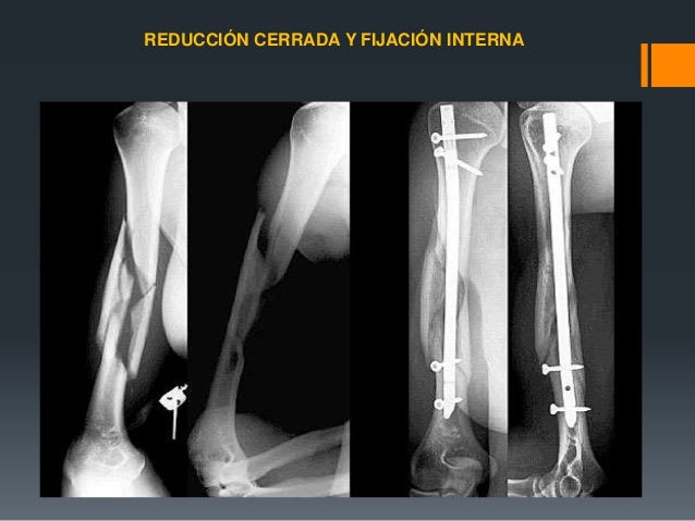 Fracturas de diafisis del humero