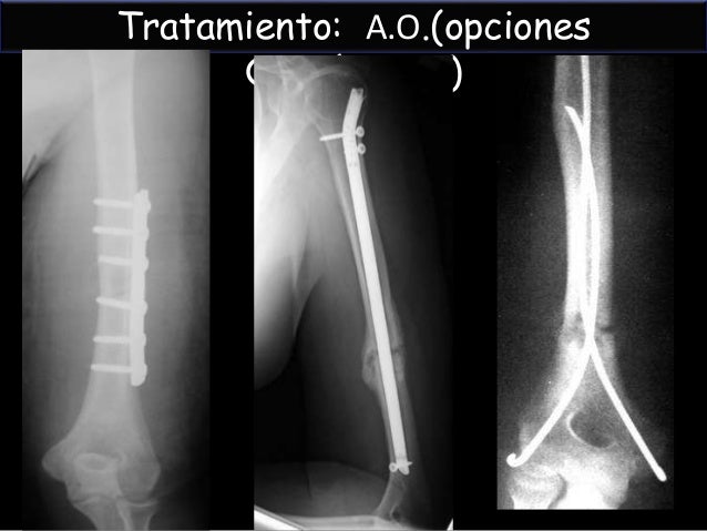 Fracturas de diafisis humeral.
