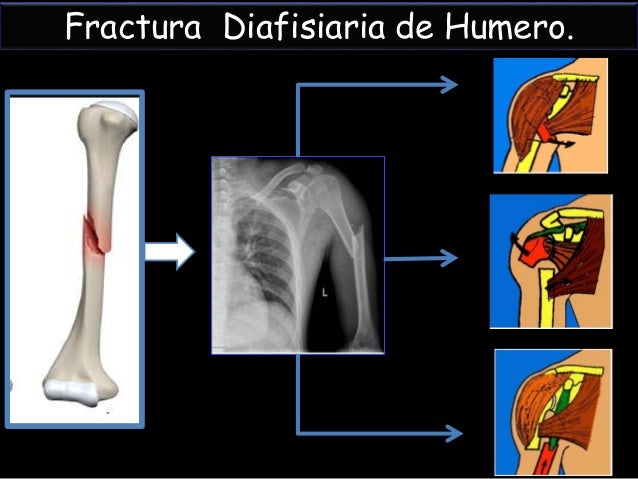 Fracturas de diafisis humeral.