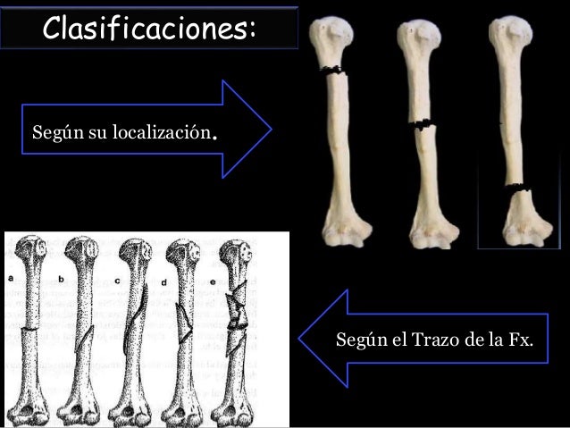 Fracturas de diafisis humeral.