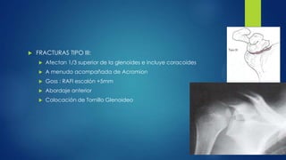 Fracturas de escapula | PPTX