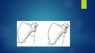 Fracturas de escapula | PPTX