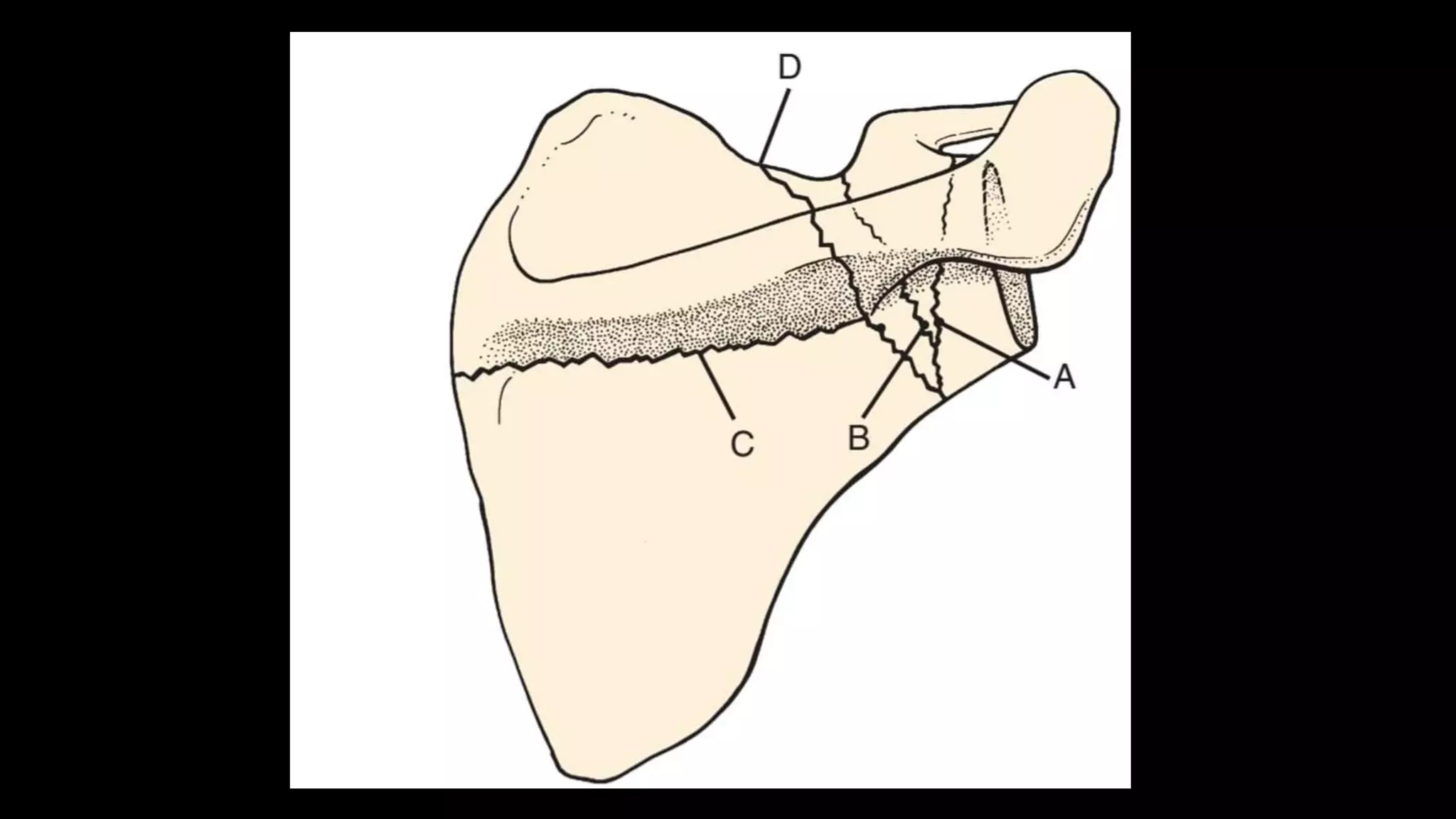 Fracturas de Escapula.pptx