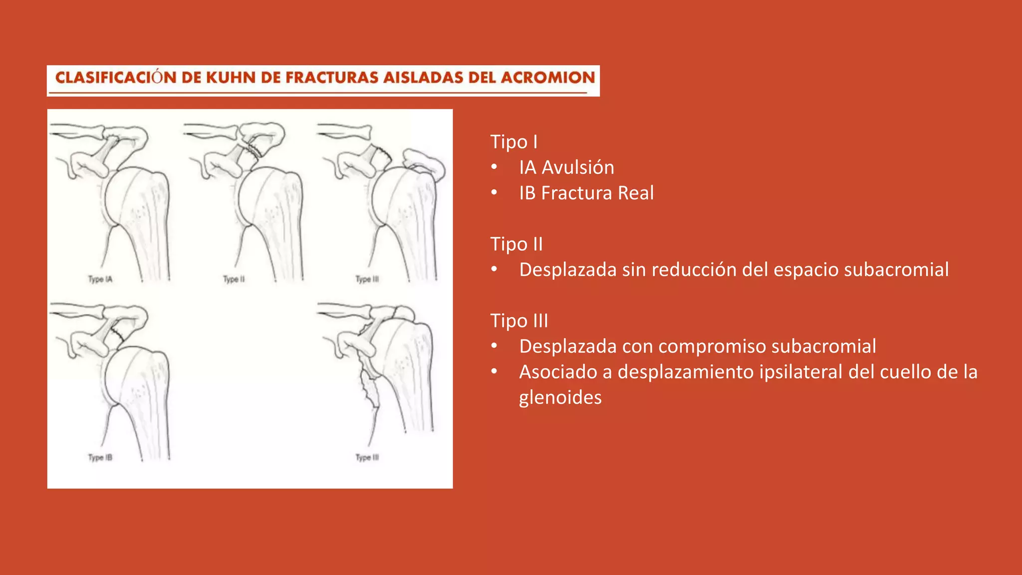 Fracturas de Escapula.pptx