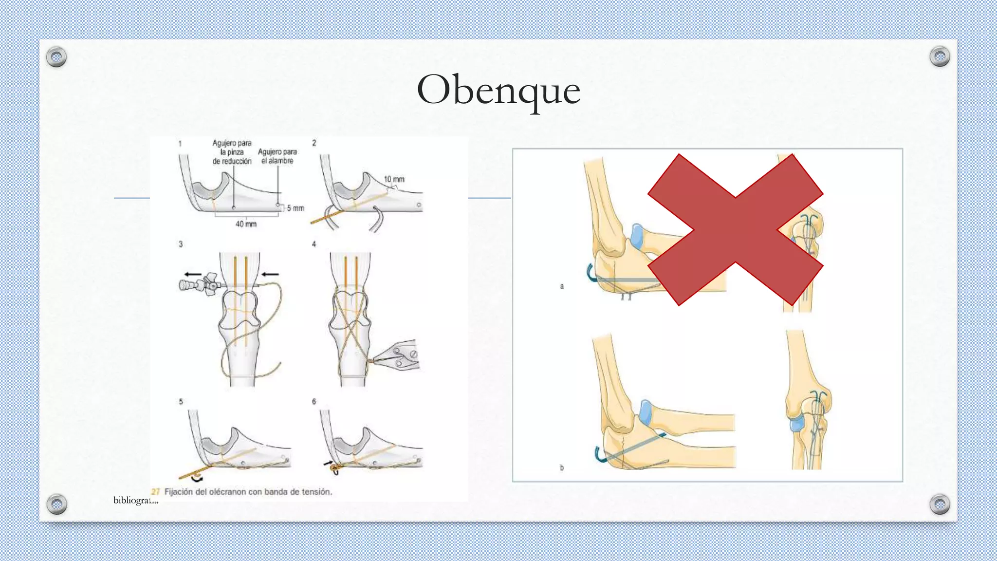 FRACTURAS DE EXTREMO PROXIMAL DE CUBITO Y RADIO hospital.pptx