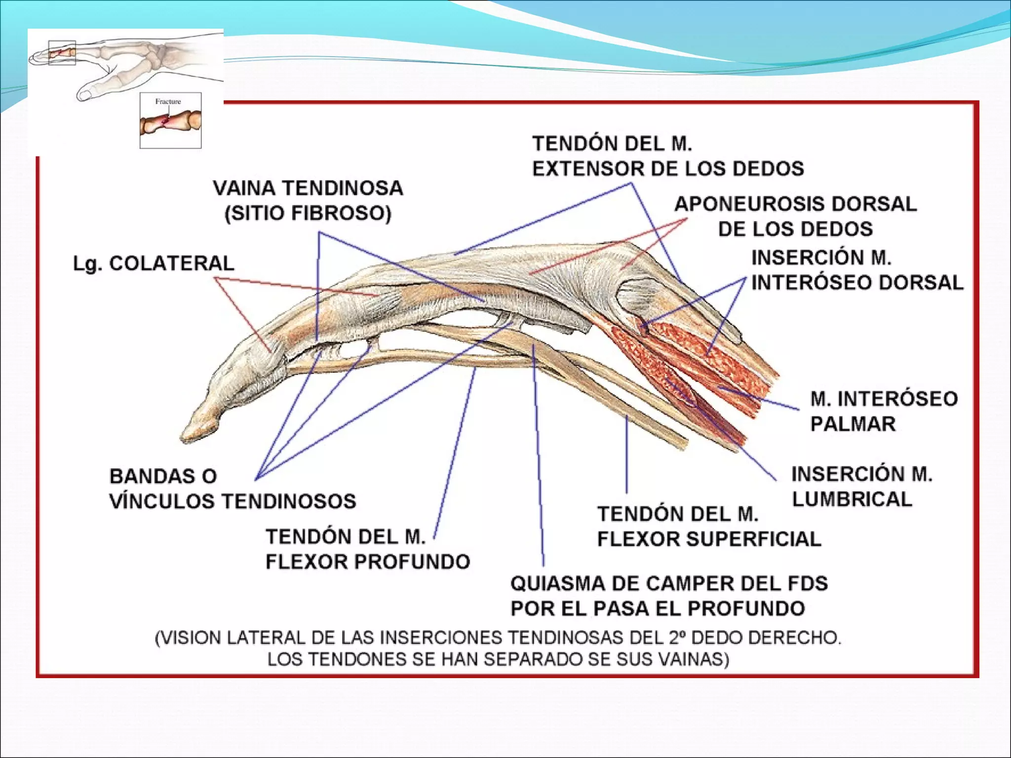 Fracturas de falanges completa 2 | PPT | First Aid | Injuries