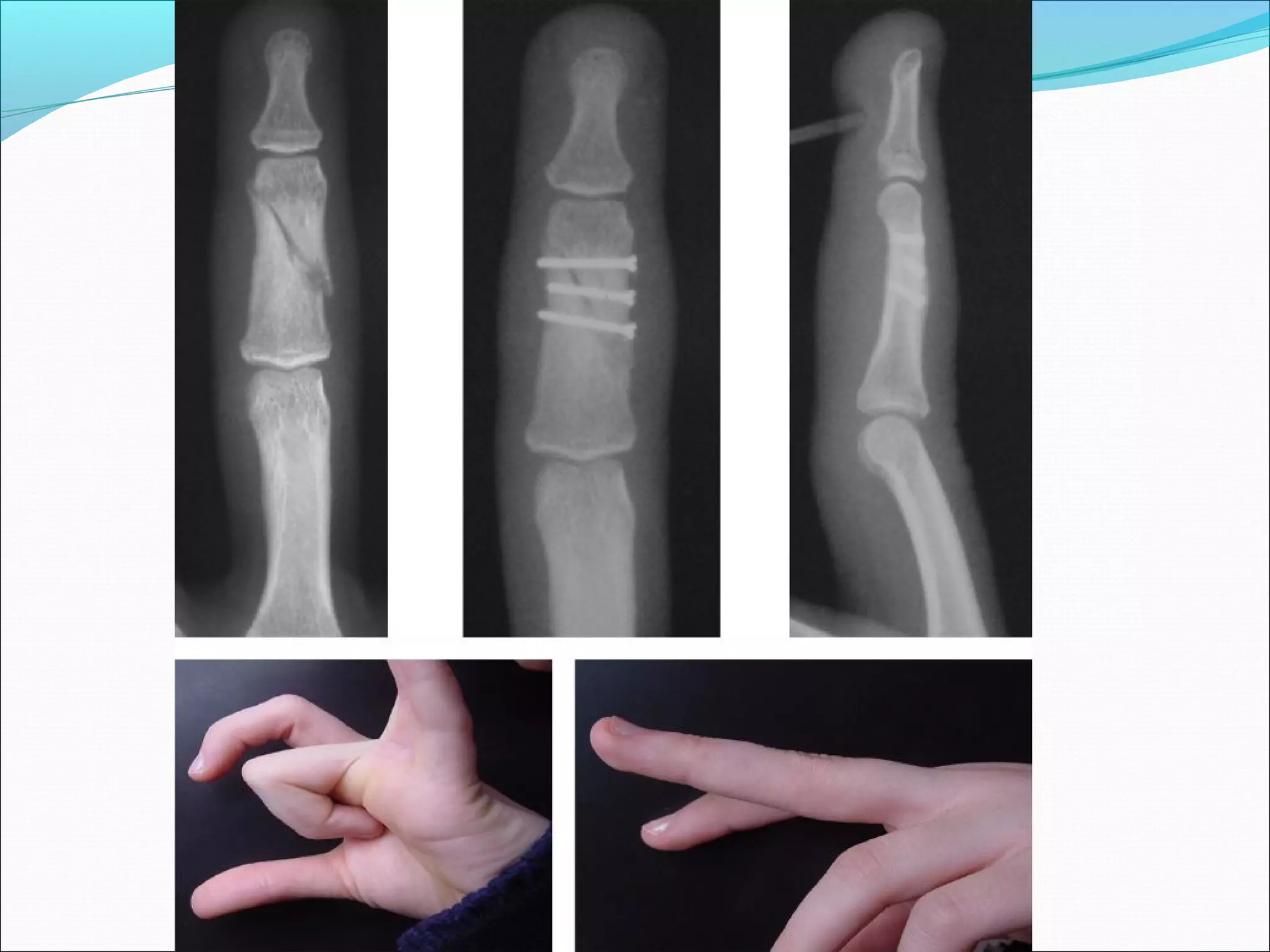 Fracturas de falanges completa 2 | PPT | First Aid | Injuries