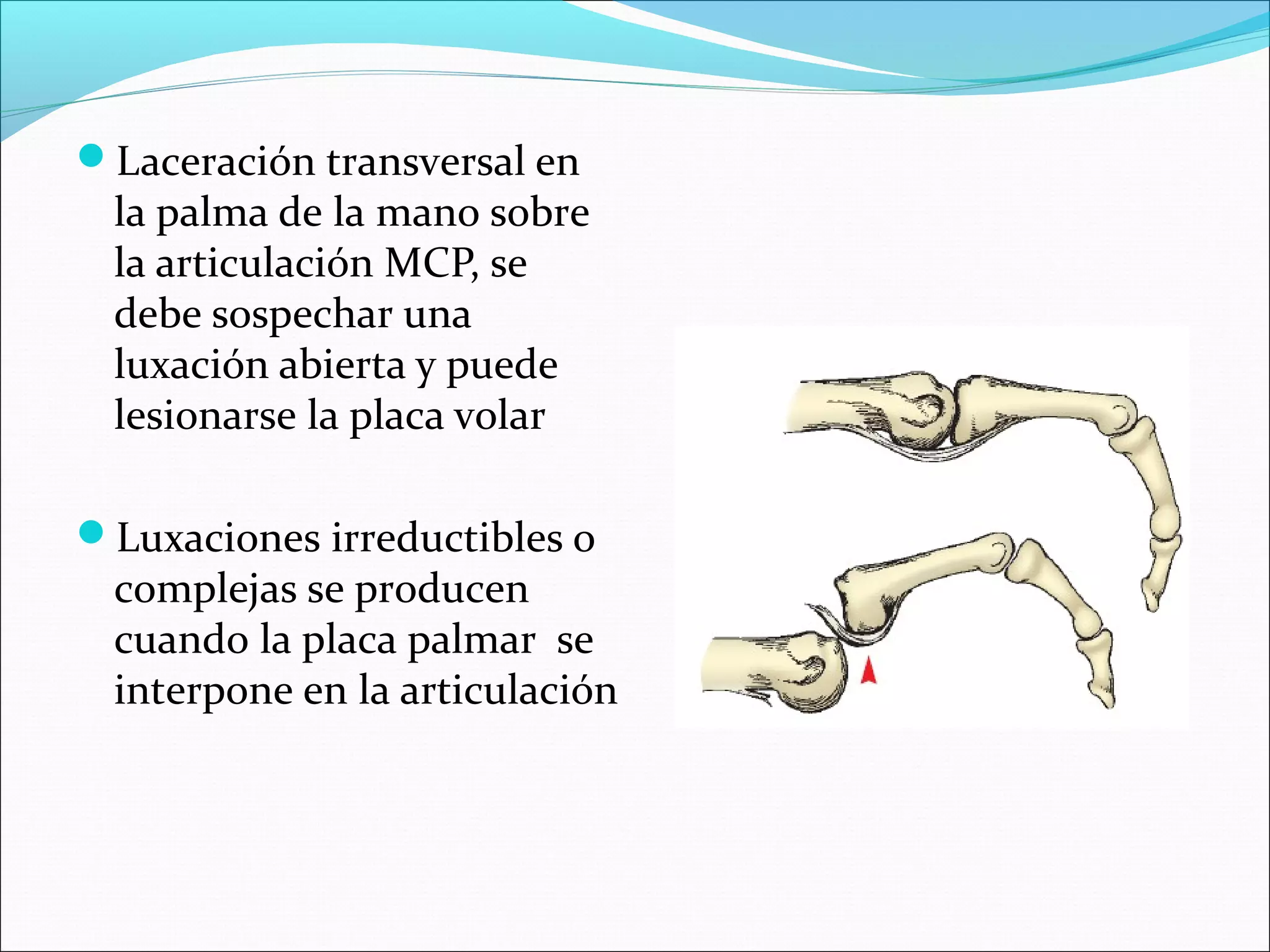 Fracturas de falanges completa 2 | PPT | First Aid | Injuries