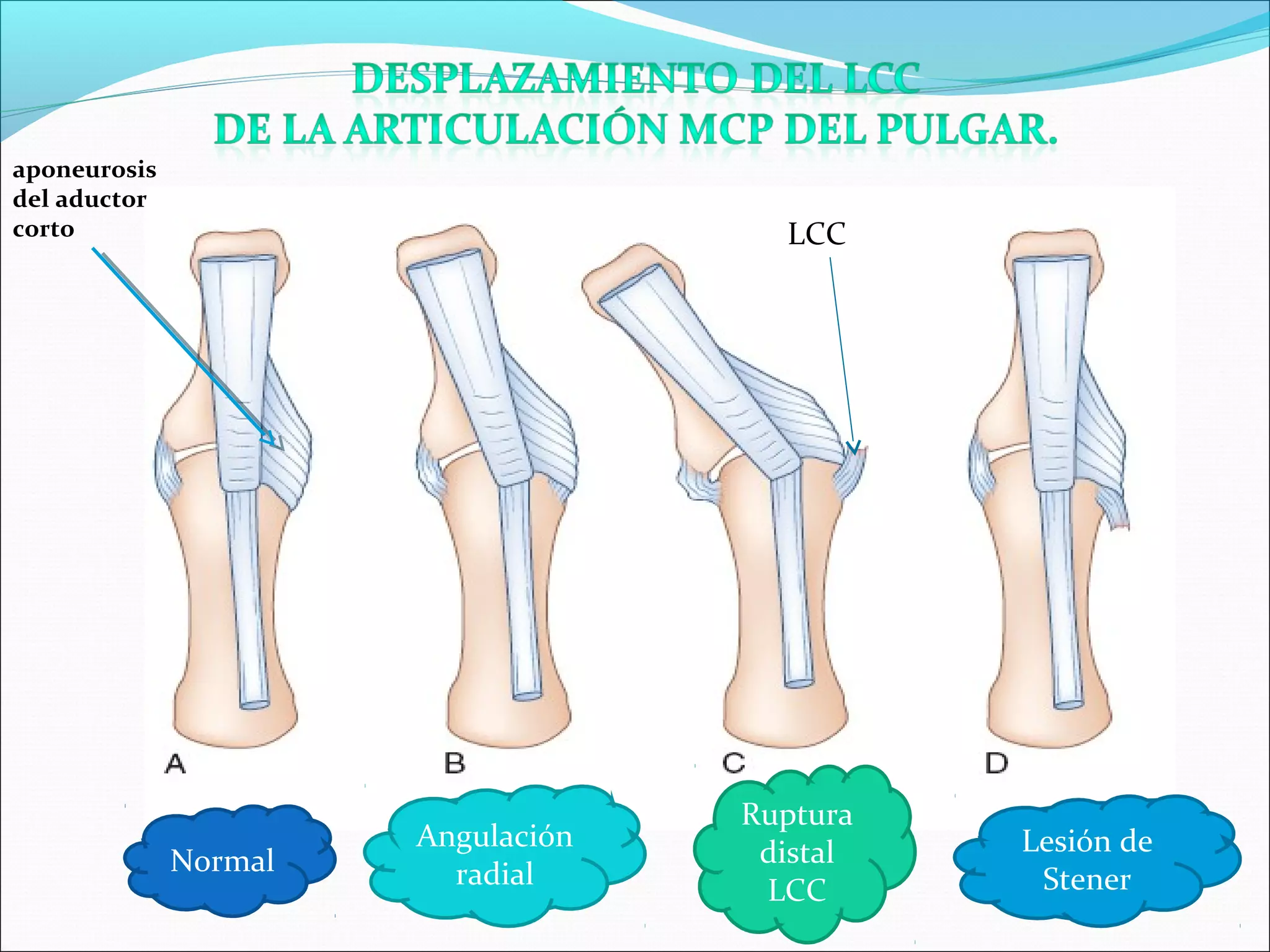 Fracturas de falanges completa 2 | PPT | First Aid | Injuries