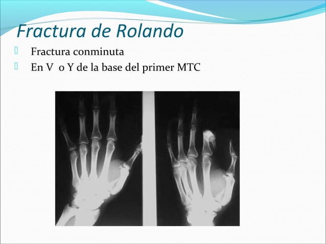 Fracturas de falanges completa 2 | PPT | First Aid | Injuries