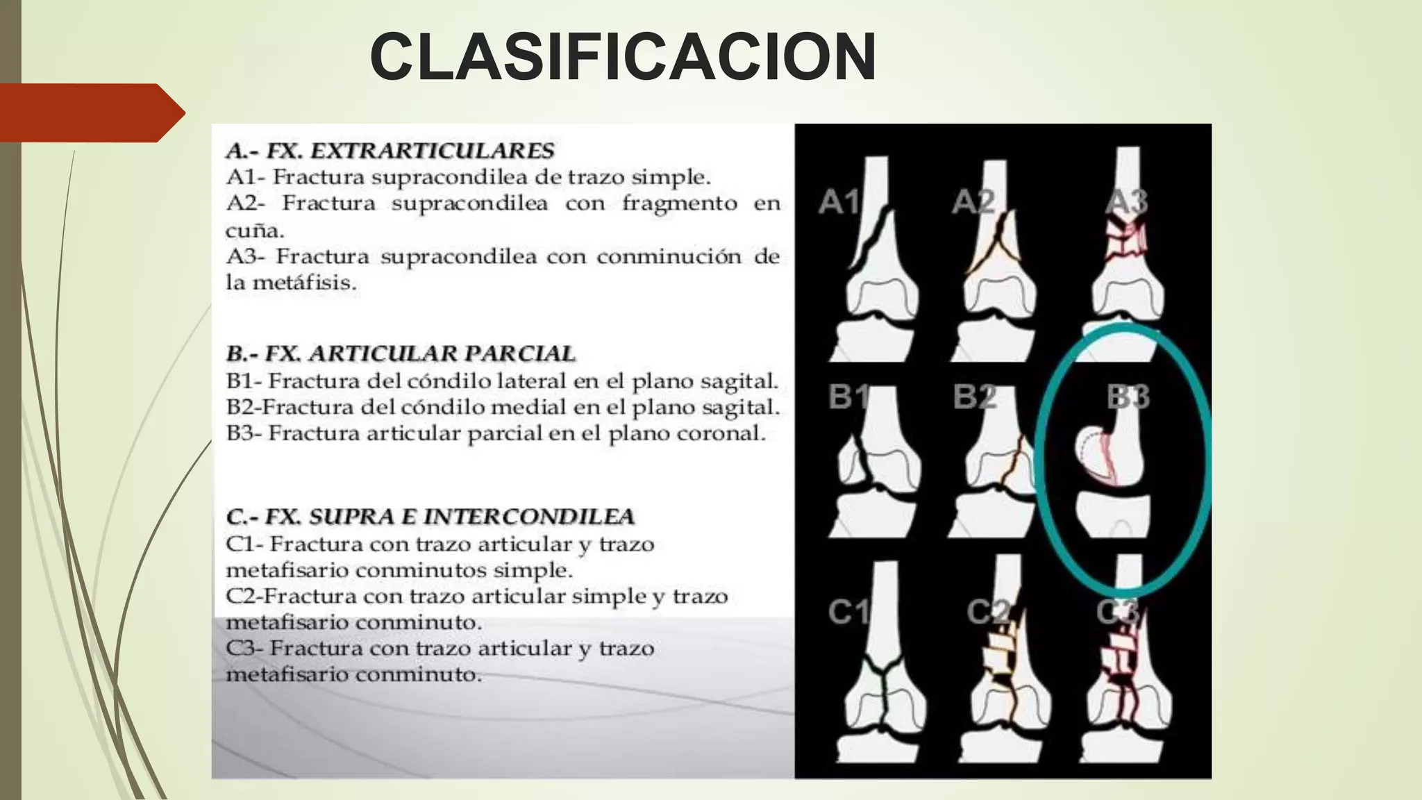 Fracturas de femur distal y lesiones de rodilla | PPT