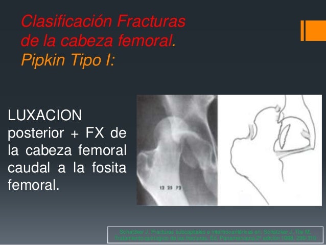 Fracturas de femur proximal