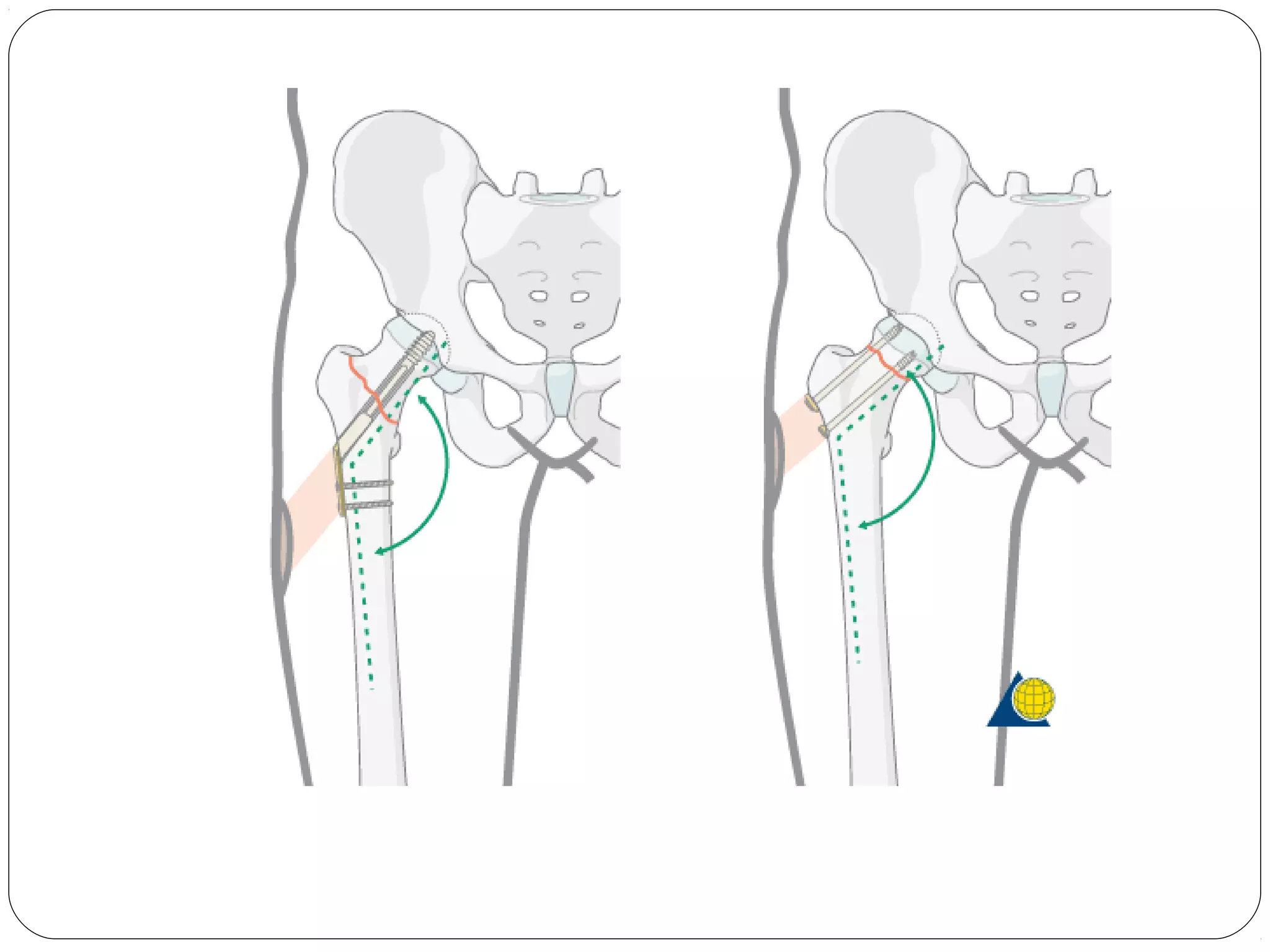 Fracturas de femur proximal 31 b | PPT