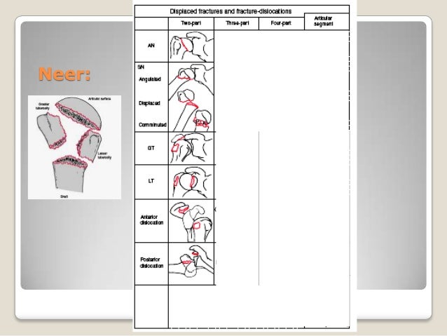 Fracturas de húmero manejo conservador